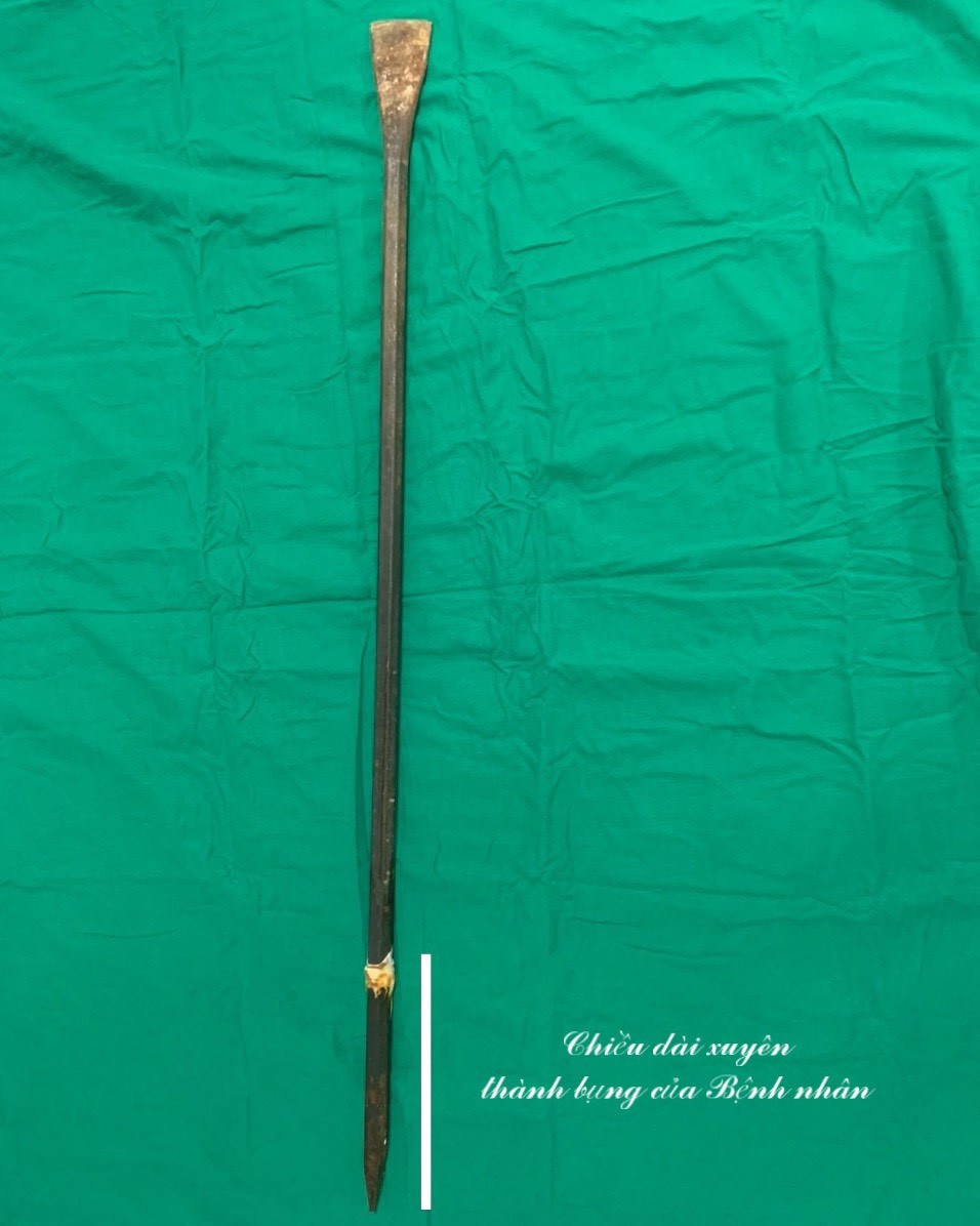Chiếc xà beng dài hơn 1m đâm xuyên thành bụng người đàn ông 61 tuổi ...